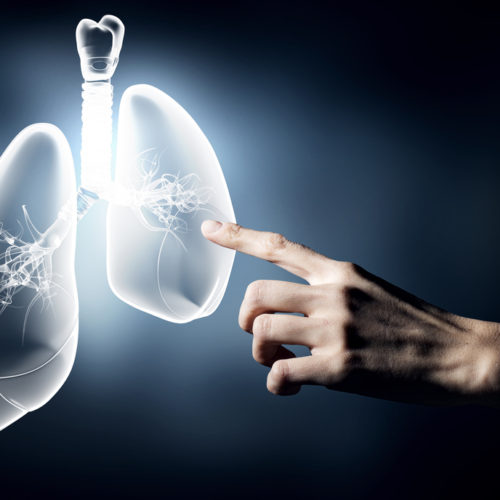 Lung Cancer Archives - Florida Lung, Asthma & Sleep Specialists Lung Cancer Archives - Florida Lung, Asthma & Sleep Specialists